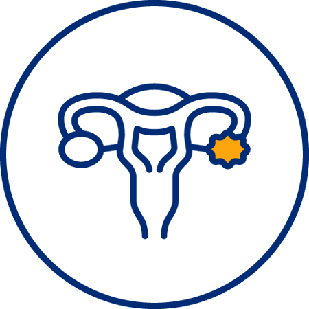 How Is Polycystic Ovary Syndrome (PCOS) Diagnosed?